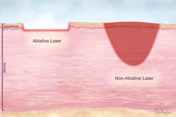 It's Laser Season! Skin care tips pre & post laser resurfacing ...